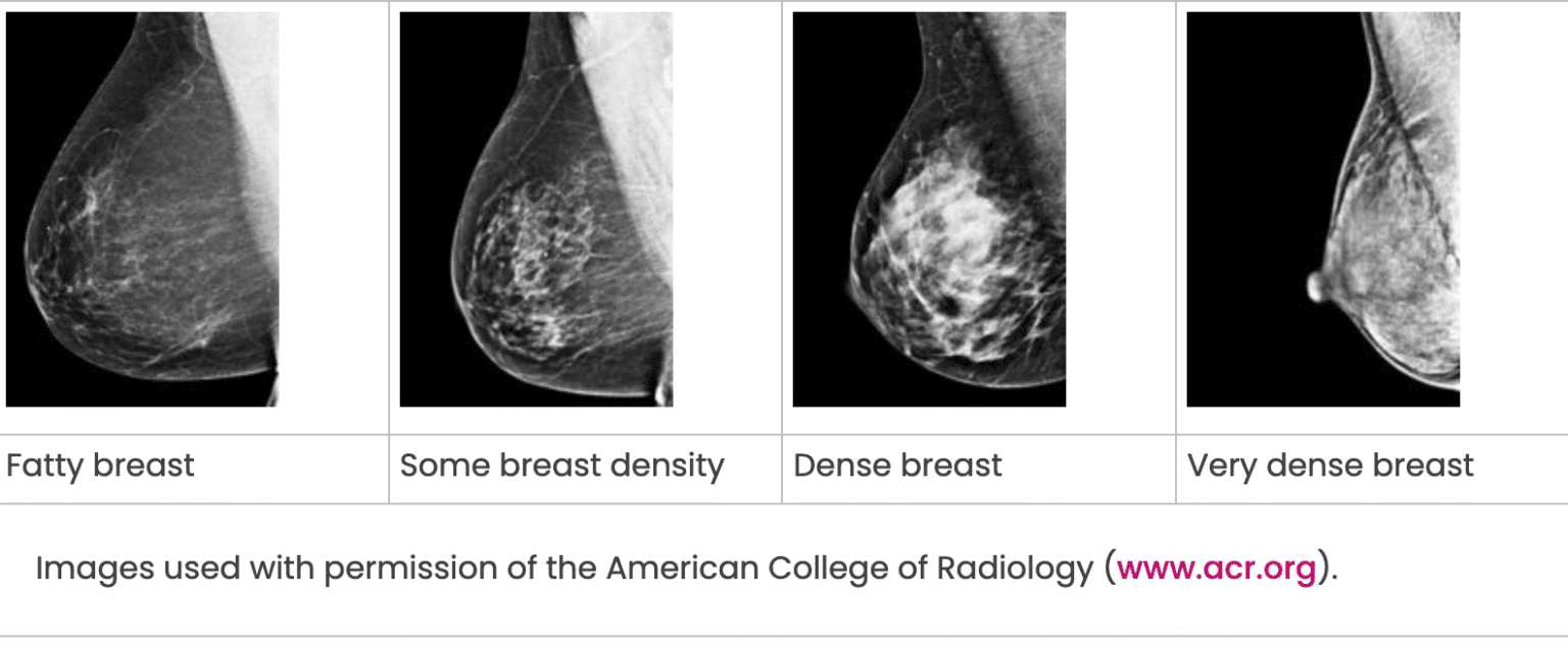 You’re Not Too Young, Bestie: What to Know About Dense Breasts - Susan ...